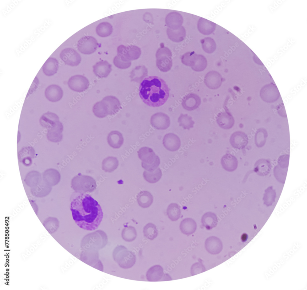 Blood smear show anisocytosis and target cells, Macrocytic anemia ...