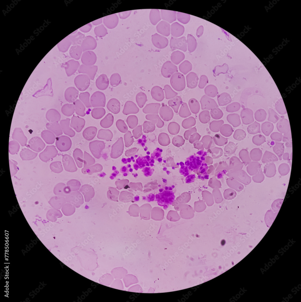 Blood smear show anisocytosis and target cells, Macrocytic anemia with ...