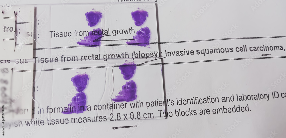 Photomicrograph of Rectal cancer histological slide with sample and ...