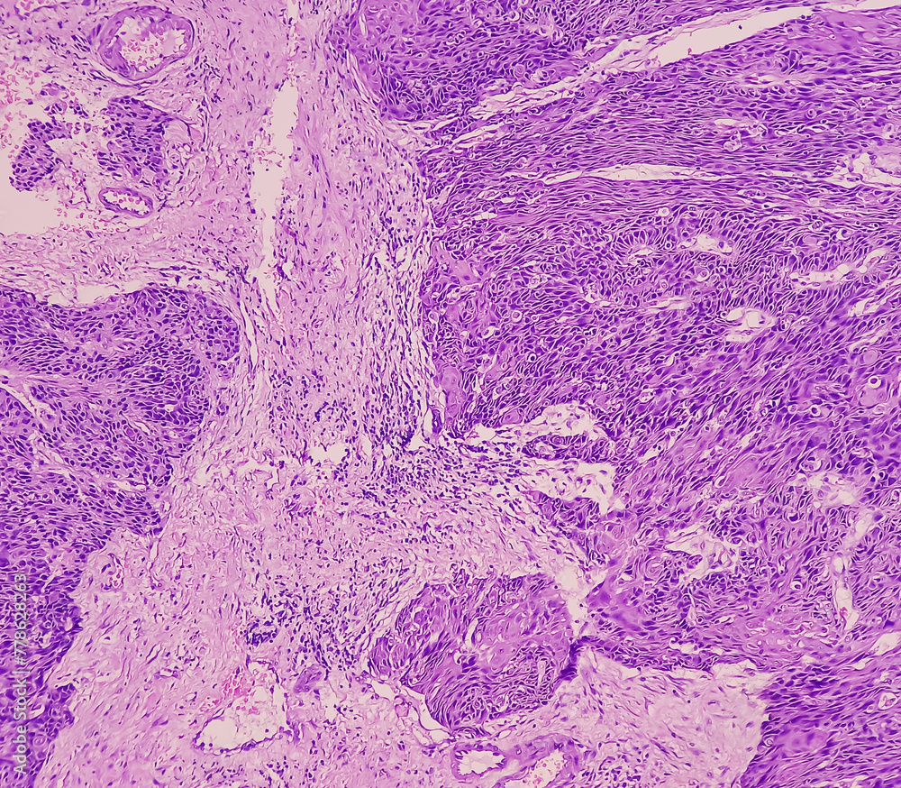 Photomicrograph of Rectal cancer. IBD. IBS. Squamous cell carcinoma of ...