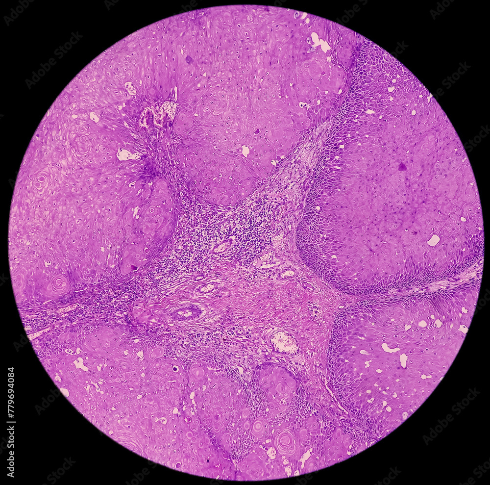 Breast cancer. Invasive squamous cell carcinoma of areola of breast ...