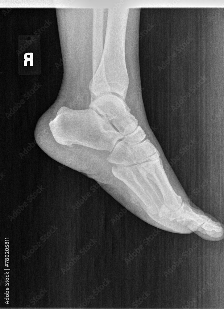 Film xray or radiograph of a normal foot, ankle and leg. Lateral view ...