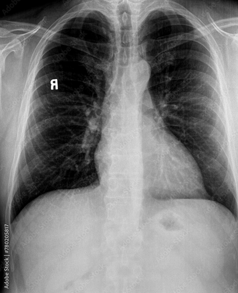 Chest xray of of patient with emphysematous lungs, hilar adenopathy ...