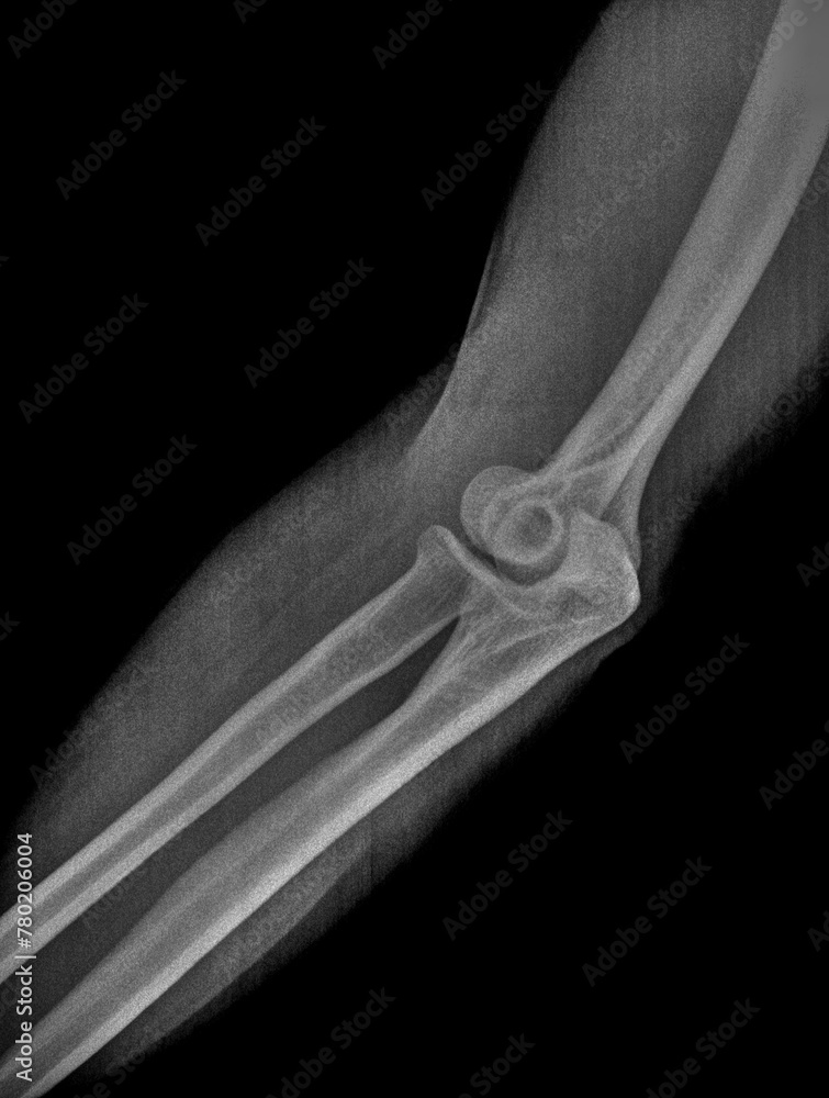 Photo Stock Film x ray or radiograph of a normal adult elbow. Lateral ...