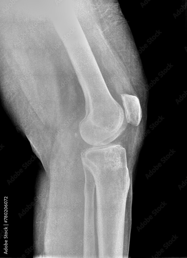 Стоковое фото «Film xray or radiograph of a normal knee. Lateral view ...
