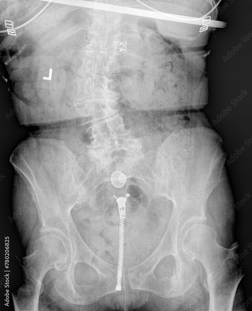Film x ray or radiograph of a normal adult lumbar vertebrae anterior ...