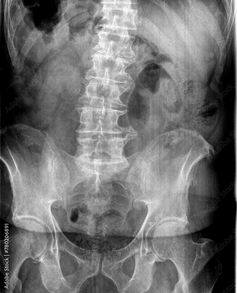 Foto de Stock Film x ray or radiograph of an adult lumbar vertebrae ...