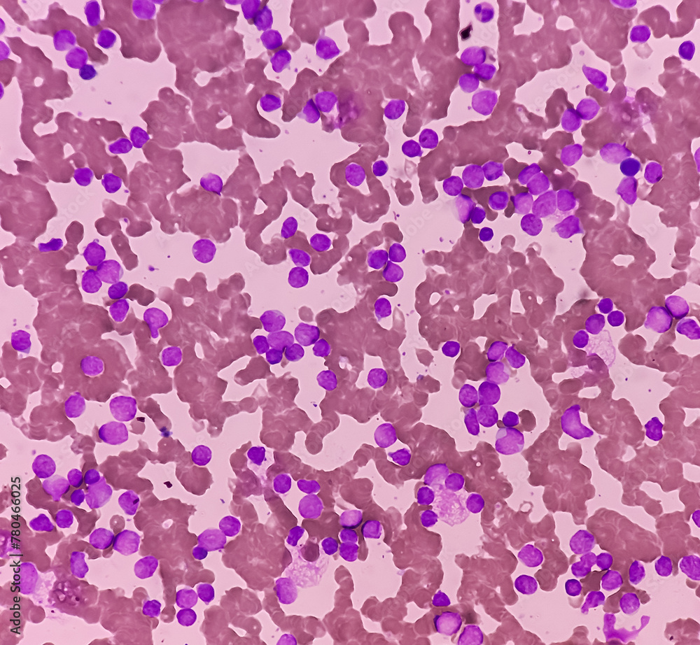 Acute leukemia, ALL(Acute lymphoblastic leukemia), peripheral blood ...