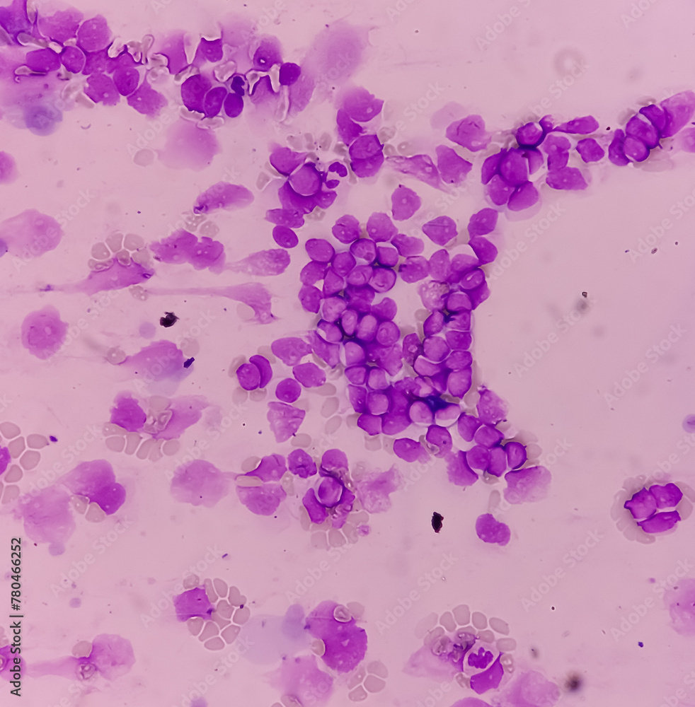 Acute leukemia, ALL(Acute lymphoblastic leukemia), peripheral blood ...