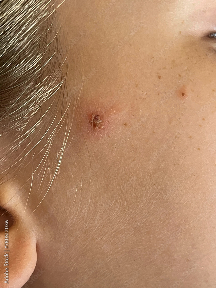 Virus or bacterial infection. Scratched pimples on human skin close up ...