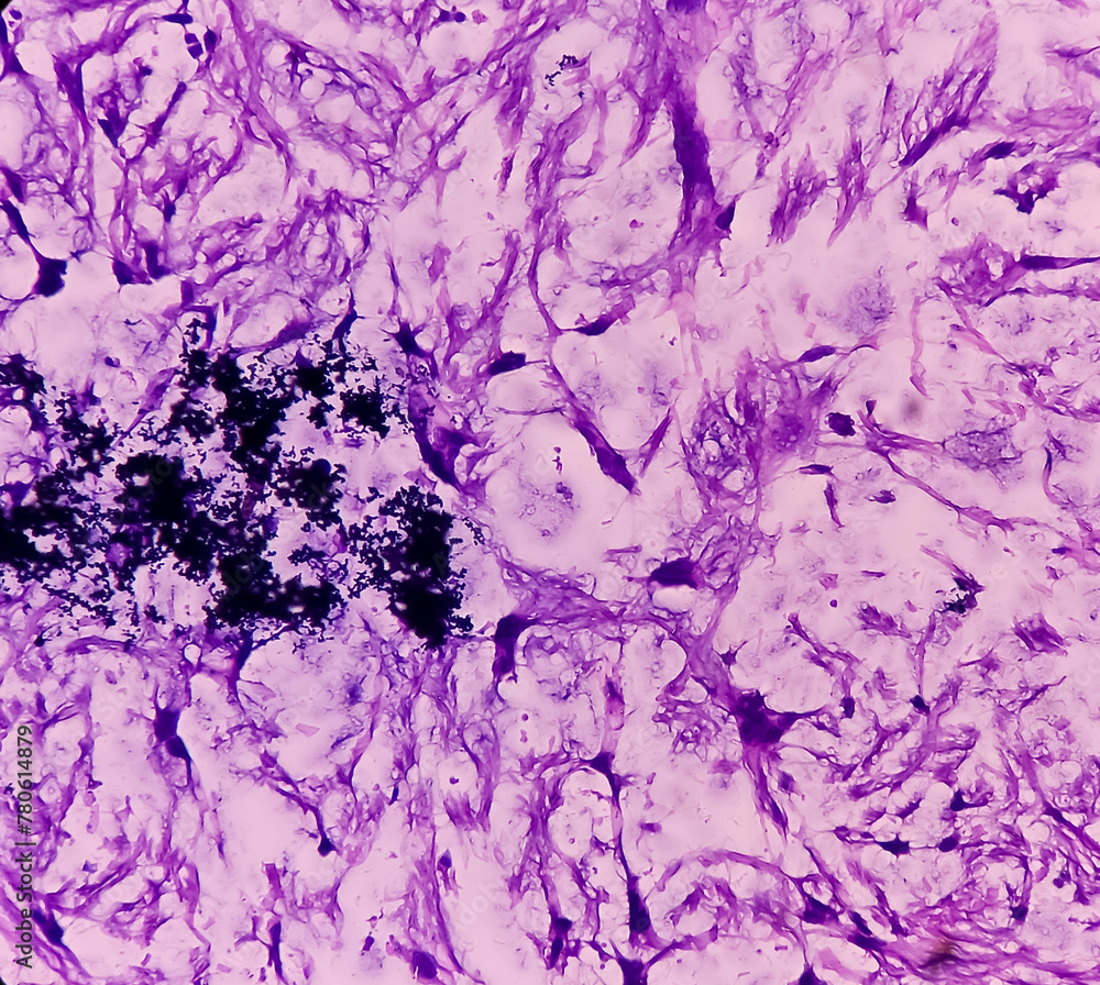 Stock-Illustration „Salivary mucoid cyst. microscopic show parotid ...