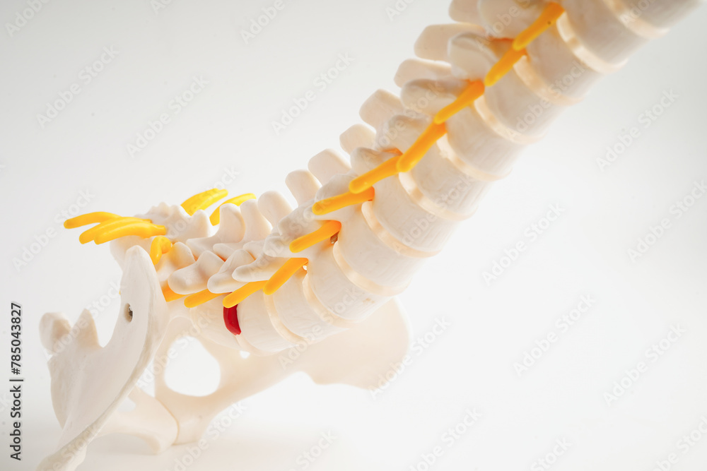 Spinal nerve and bone, Lumbar spine displaced herniated disc fragment ...