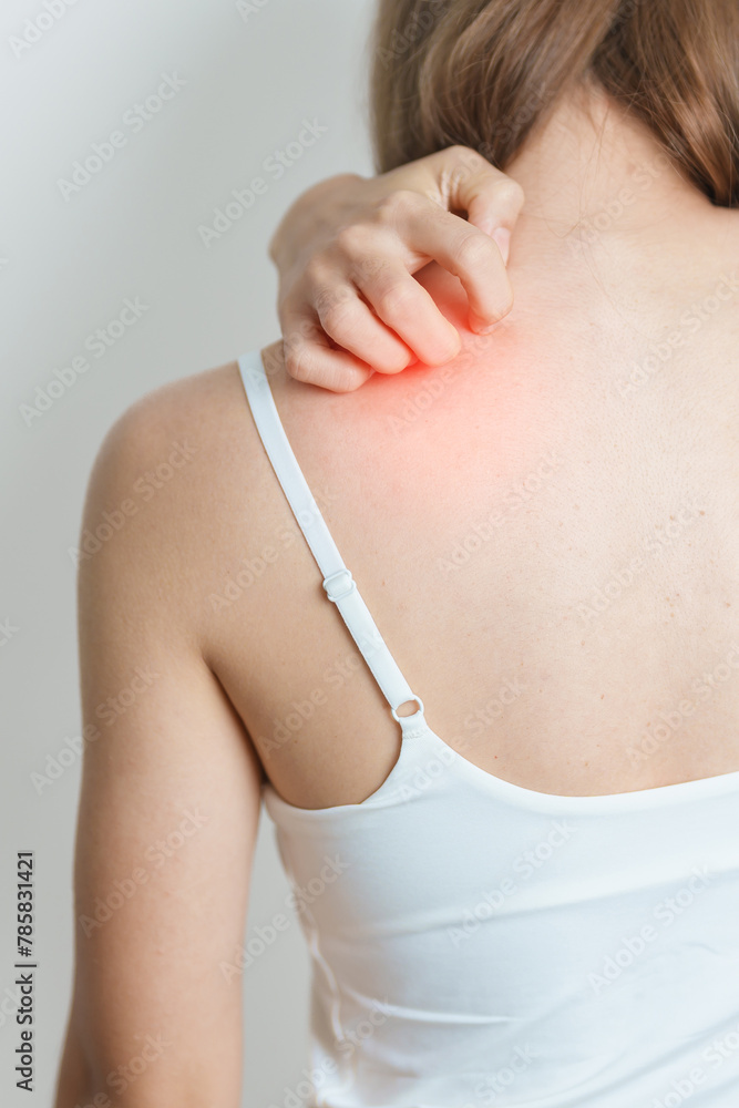 woman itching and scratching itchy back. Sensitive Skin Allergic reaction to insect bite, food ...