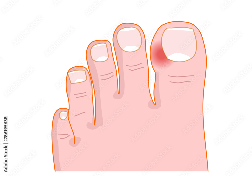 Paronychia is an infection of the proximal and lateral toenail and ...