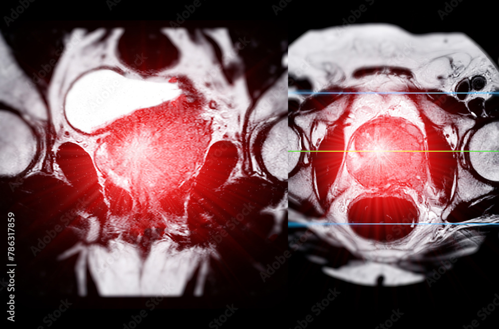 MRI of the prostate gland reveals a focal abnormal signal intensity (SI ...