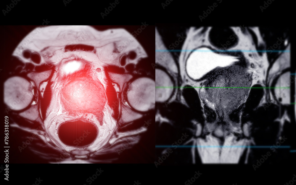 MRI of the prostate gland reveals a focal abnormal signal intensity (SI ...