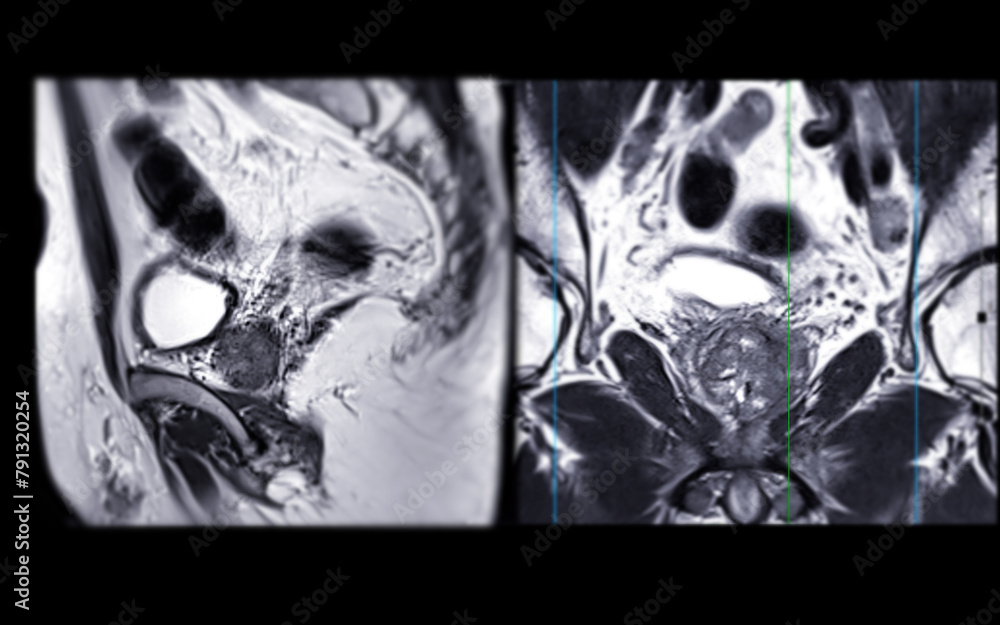 MRI of the prostate gland reveals Focal abnormal SI lesion at left PZpl ...