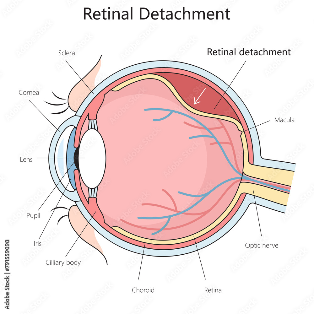human eye anatomy showcasing retinal detachment, including cornea, lens, and optic nerve ...