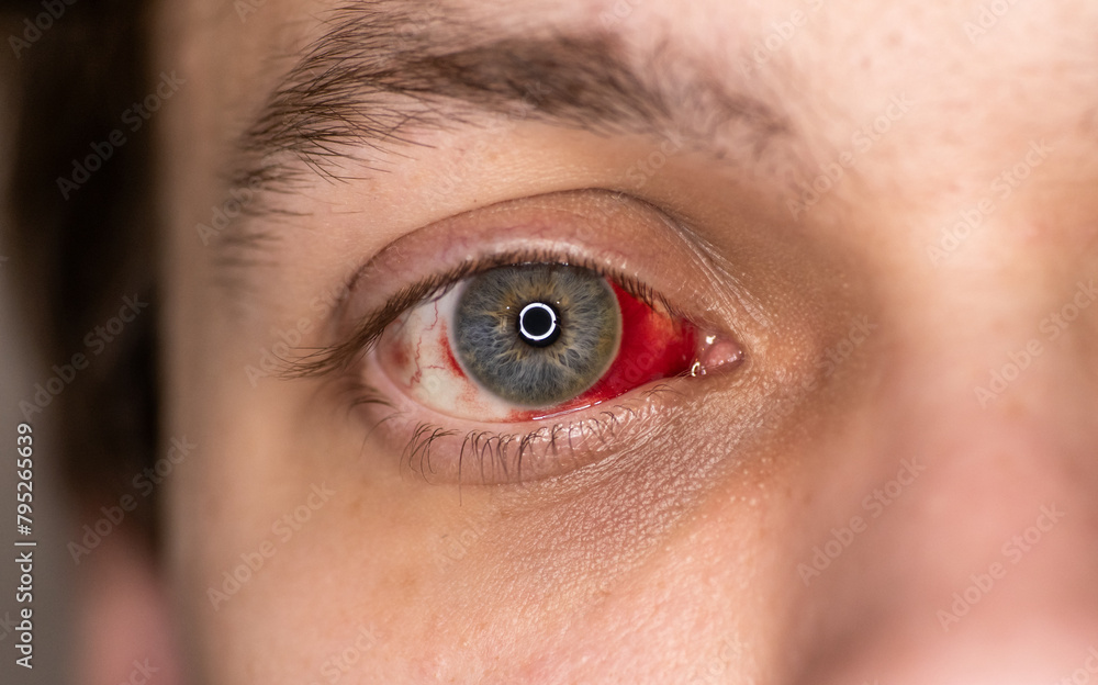 Bloodshot human eye with noticeable subconjunctival hemorrhage. Blood ...