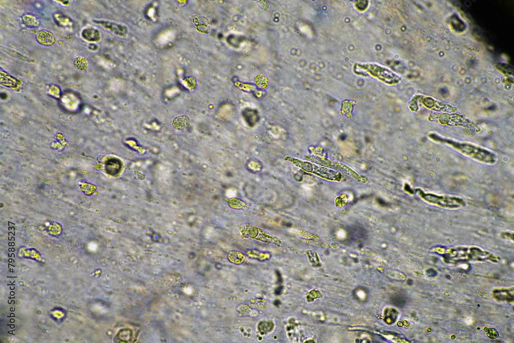 Coughing up mucus and phlegm from a chest infection from a virus and ...