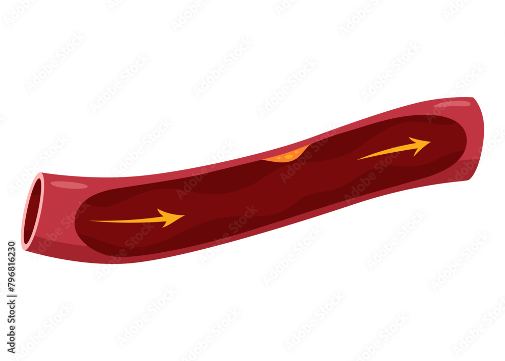 Atherosclerosis stage. Anatomy of heart attack. Arteriosclerotic ...