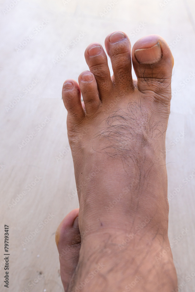 Male foot with the fourth toe shorter than usual. Mortons toe, Greek ...