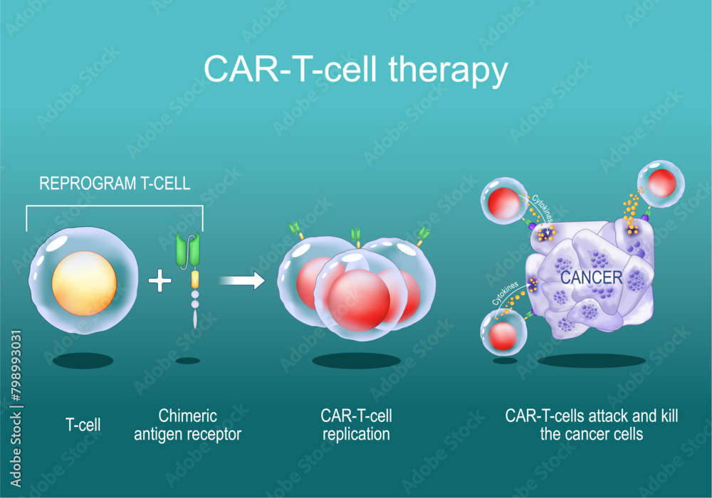 CAR T-cell therapy. cancer immunotherapy. Stock Vector | Adobe Stock