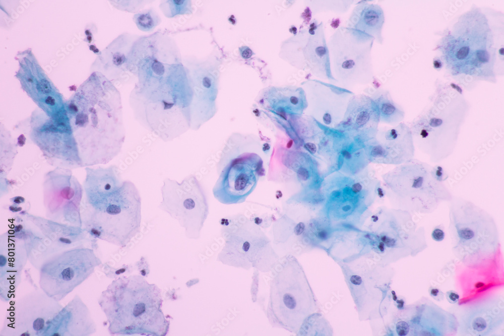Abnormal squamous epithelial cells view in microscopy.HPV criteria for ...