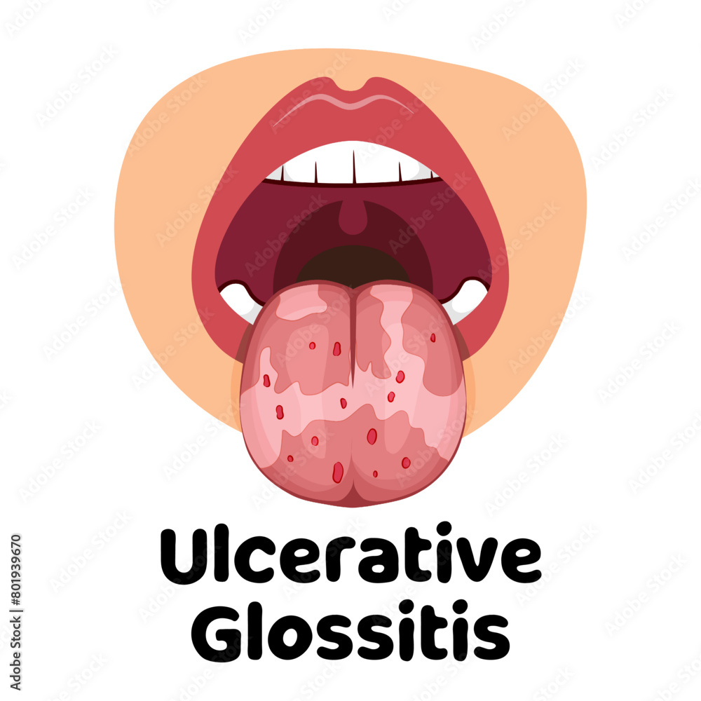 Ulcerative Glossitis vector illustration Stock Vector | Adobe Stock