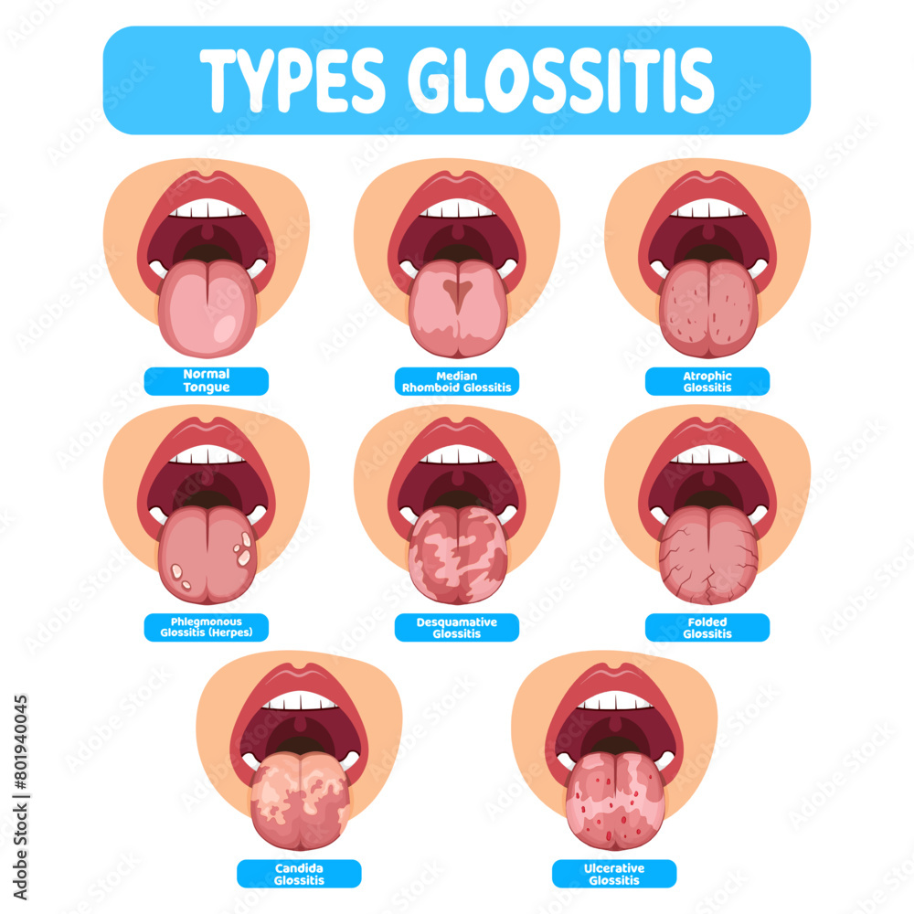 Types Glossitis vector illustration Stock Vector | Adobe Stock