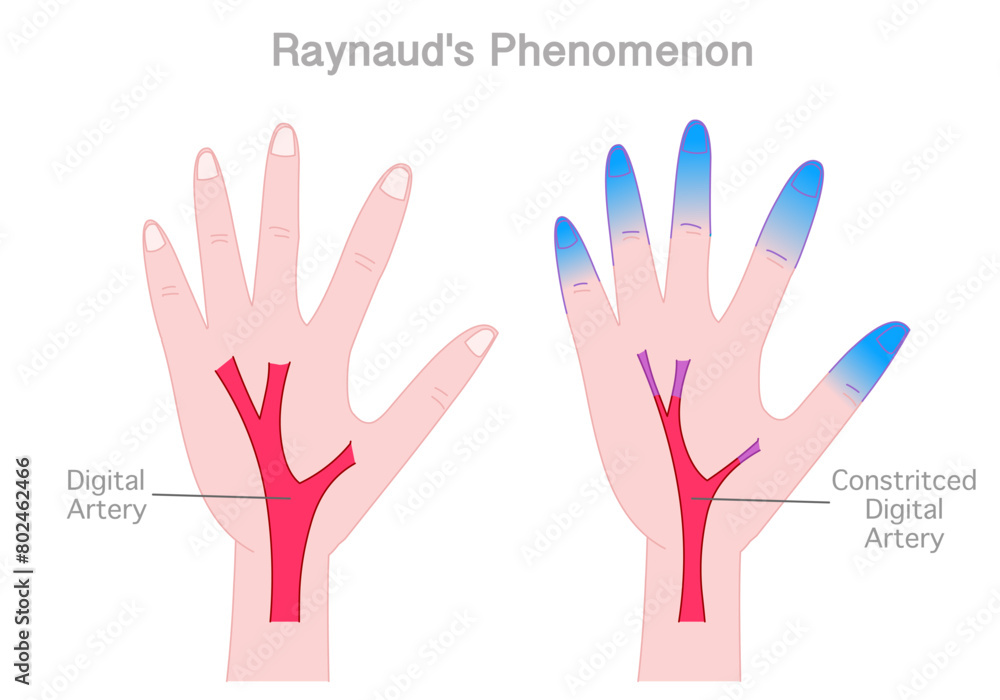 Raynaud phenomenon. Cold hands syndrome. usually Fingers and toes ...