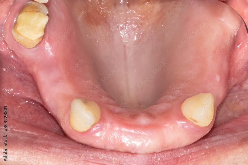 Maxillary arch occlusal view of an edentulous upper alveolar ridge ...