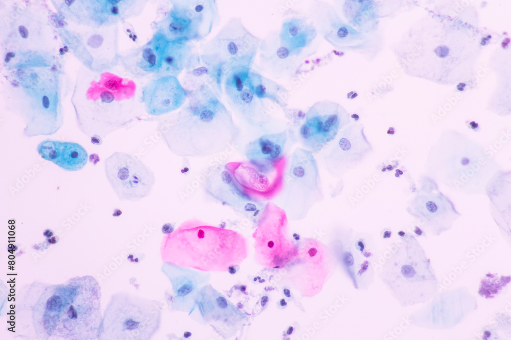 Stock-Foto „Abnormal squamous epithelial cells view in microscopy.HPV ...