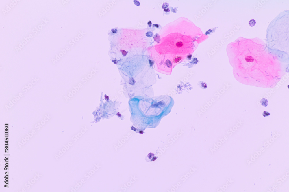 Abnormal squamous epithelial cells view in microscopy.HPV criteria for ...