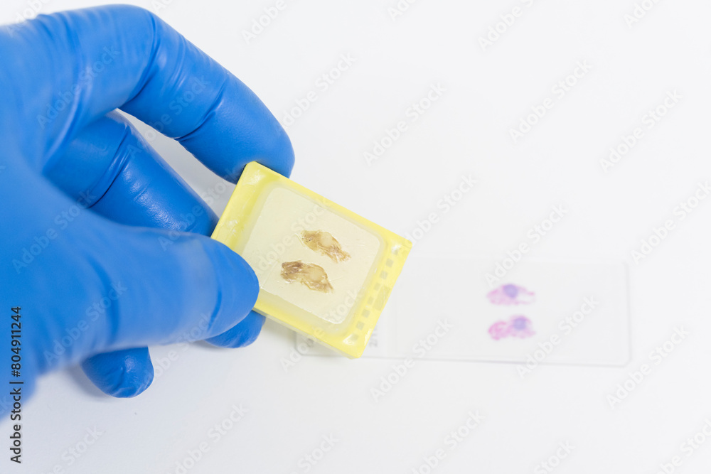 Scientist wear blue glove holding paraffin human tissue block and out ...