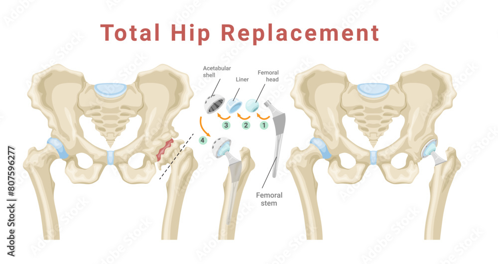 Total hip replacement surgery with anatomical acetabular prosthesis ...