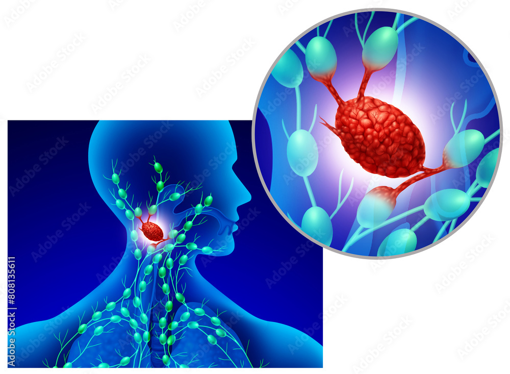 Ilustración de Stock Swollen Lymph Node as an infected gland of the ...