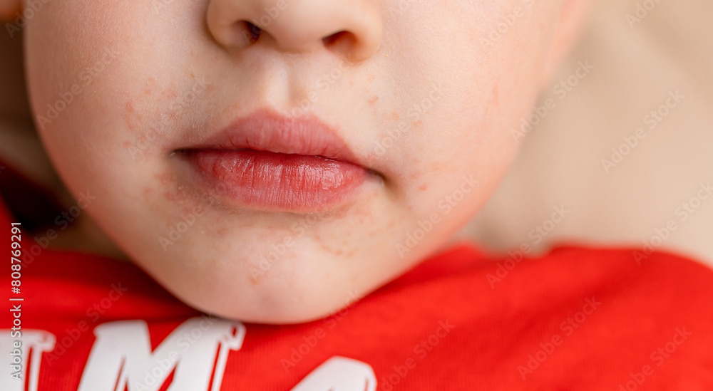 Stock-Foto „Close-up of a boy's face with red spots near the mouth ...