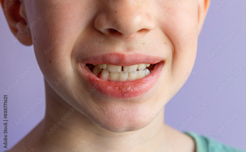 Mouth of a 9 years old boy. The child shows baby teeth. Pediatric ...