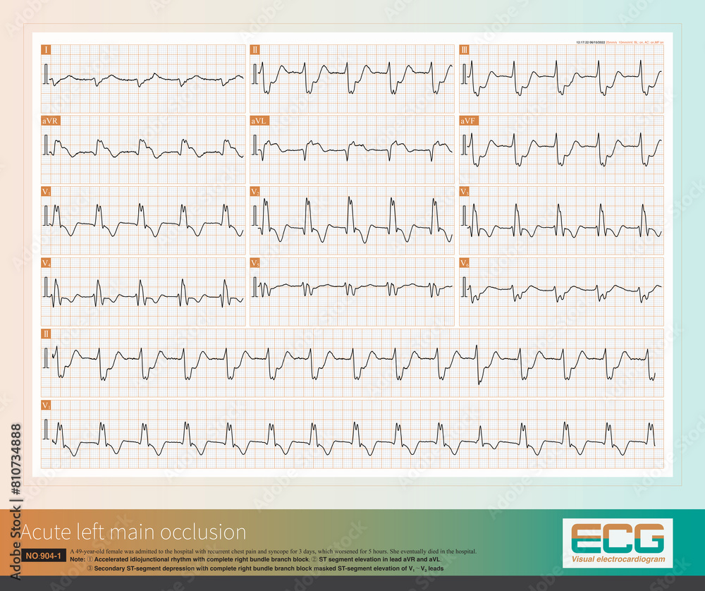 The coronary angiography showed complete occlusion of the left main ...