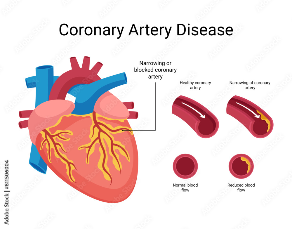 Diagram of coronary artery disease Stock Vector | Adobe Stock