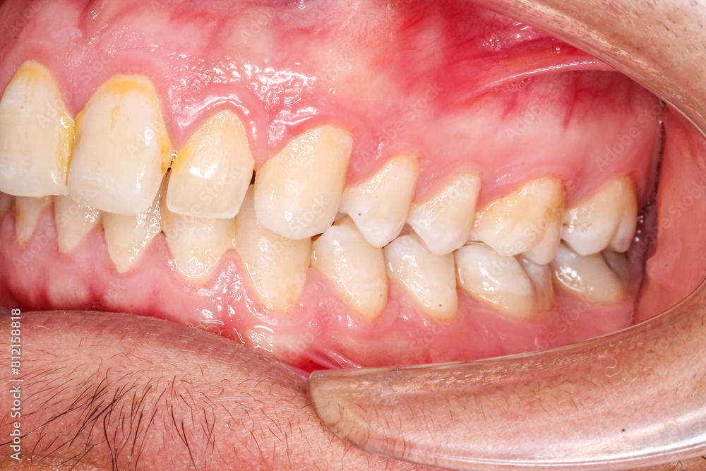 Oblique side view of dental maxillary and mandibular arches in ...
