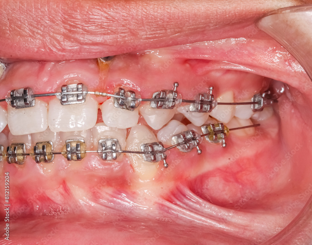 Lateral and front view of dental arches in biting teeth occlusion ...