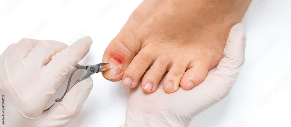 Pedicure, podologist. Patient on medical pedicure procedure, nail ...
