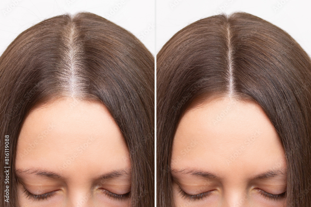 Before and after head shot of a young woman with a receding hairline on ...
