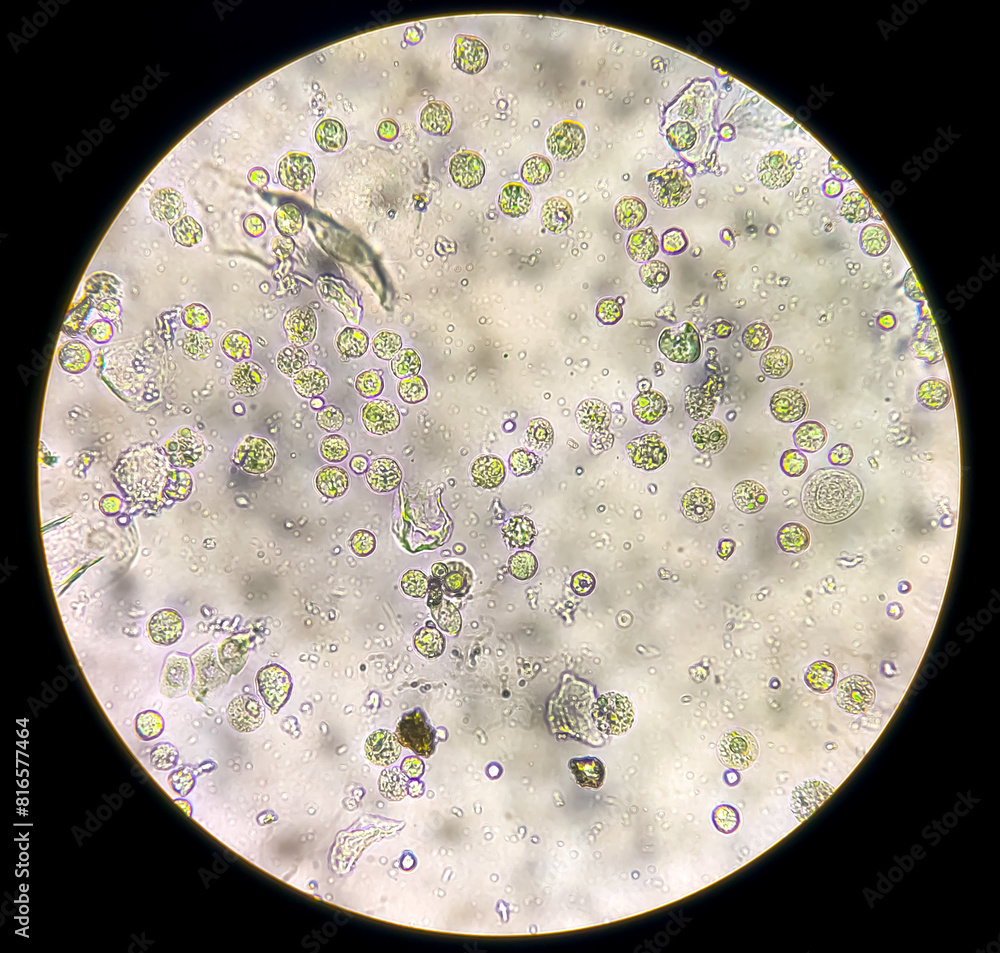 Pus cells (WBC), Red blood cells (RBC) and occasionally epithelial ...