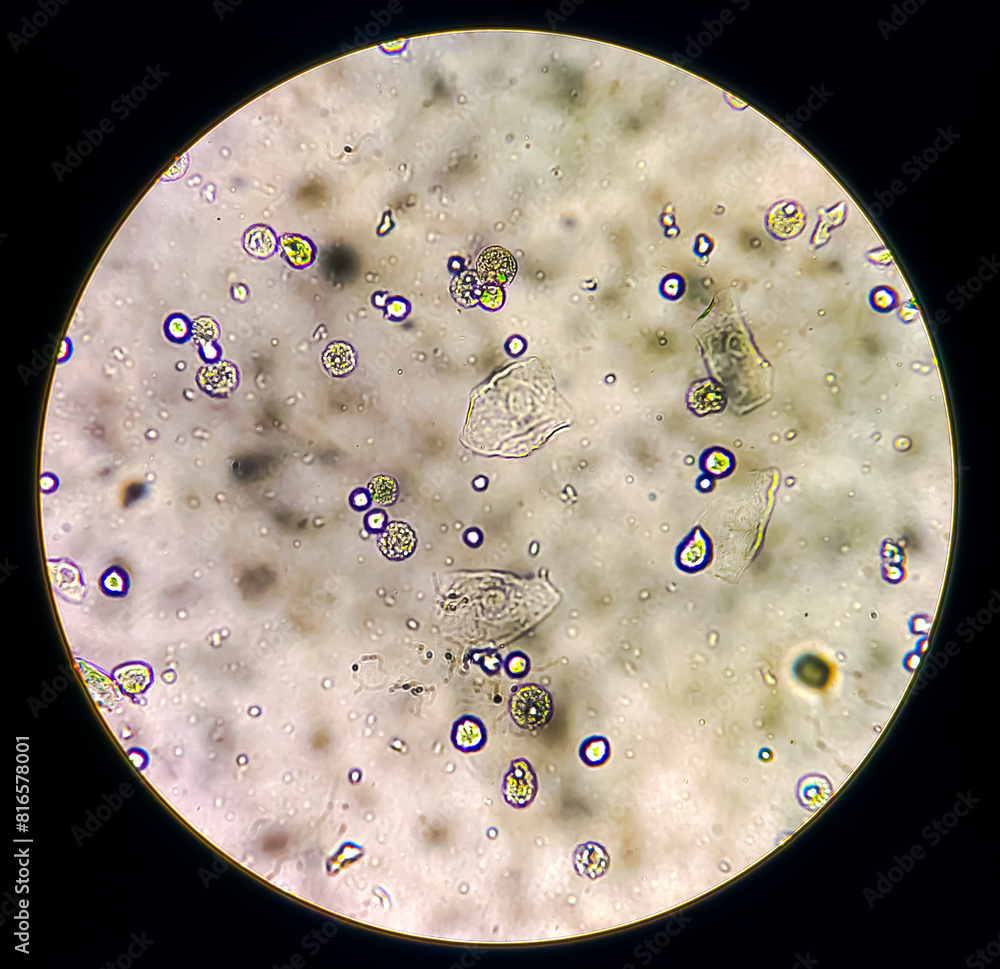 Pus cells (WBC), Red blood cells (RBC) and occasionally epithelial ...