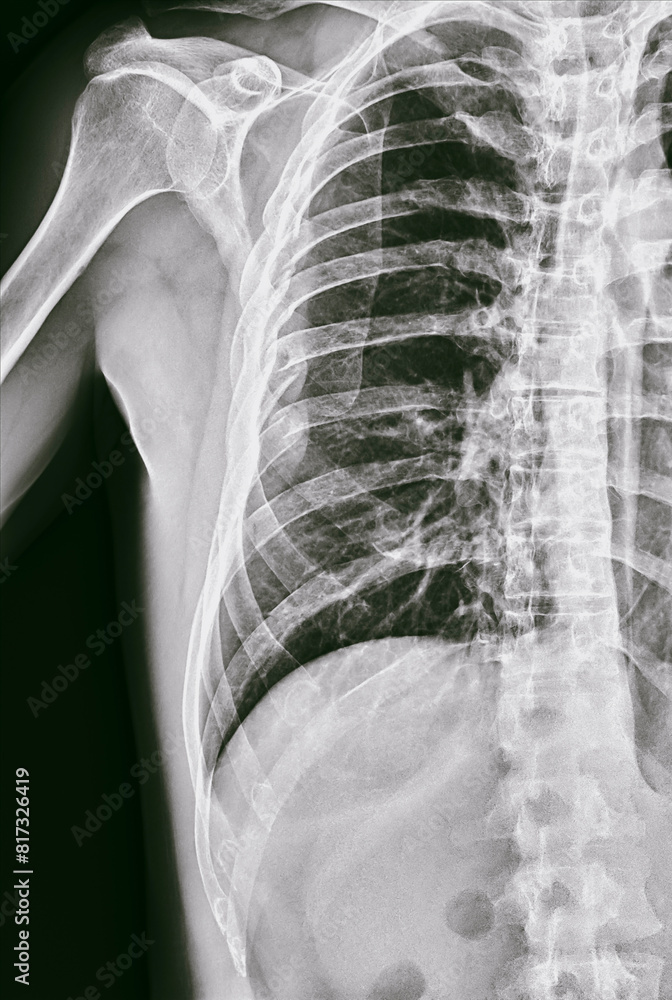 X ray radiograph right shoulder with many broken ribs and shoulder ...
