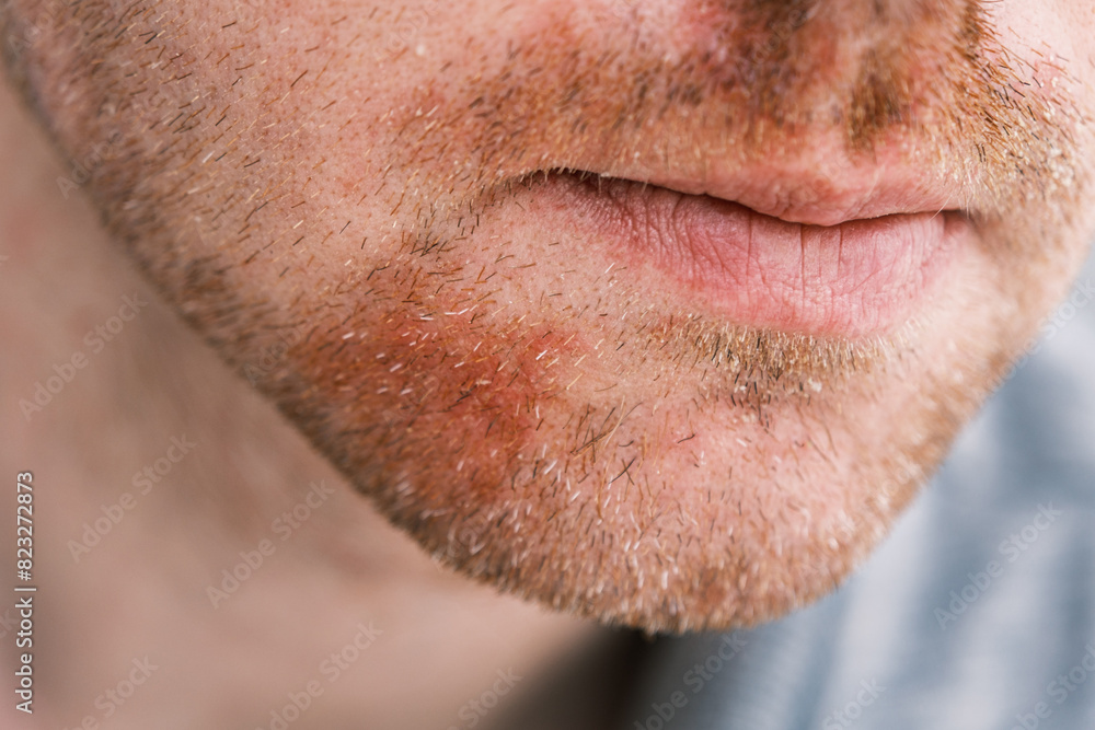 A close-up of a man's face with visible stubble and redness caused by seborrheic dermatitis ...