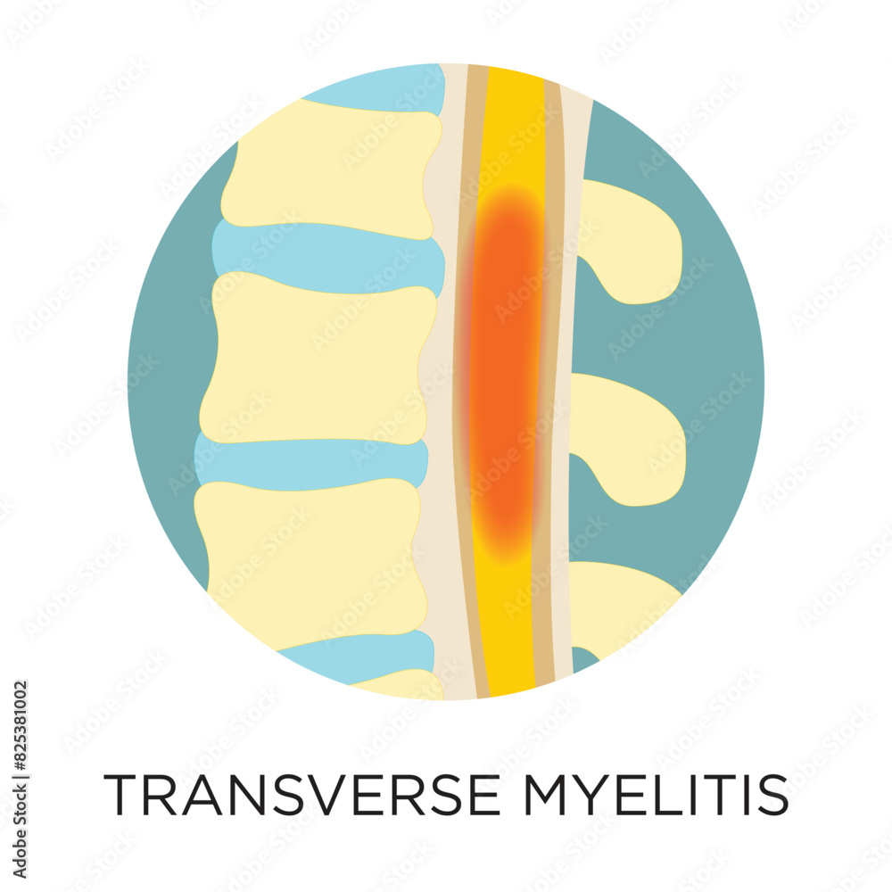 Transverse myelitis flat style vector illustration in circle layout ...